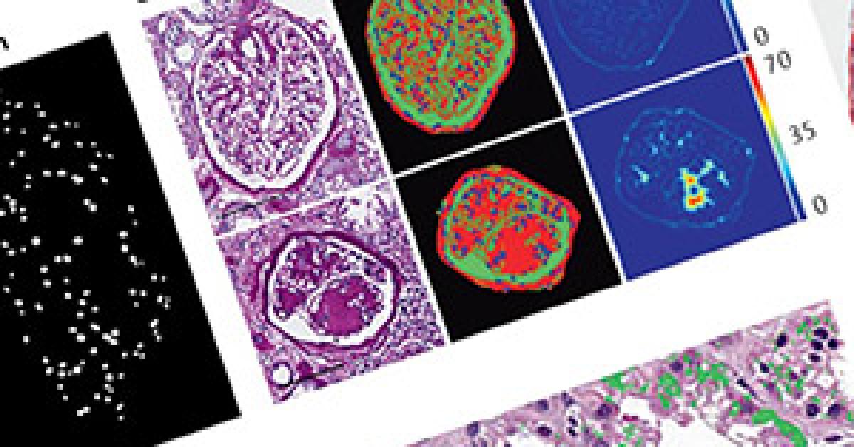 Barisoni Featured for Digital Nephropathology Research | Duke ...